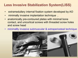 Tibial plateau fracture management .pptx