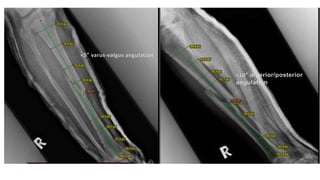tibial shaft .pptx