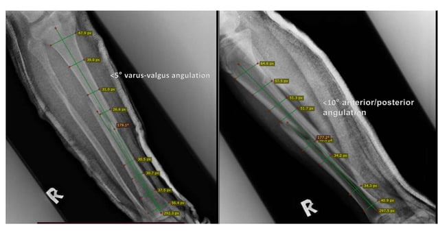tibial shaft .pptx