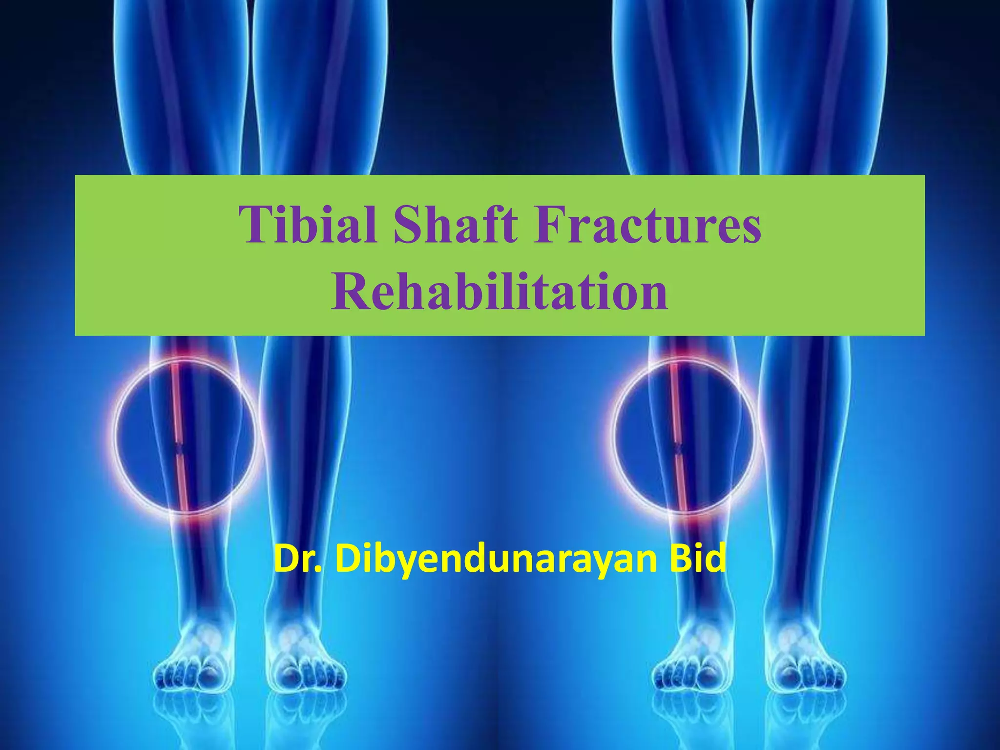 Tibial shaft fractures rehabilitation | PPTX