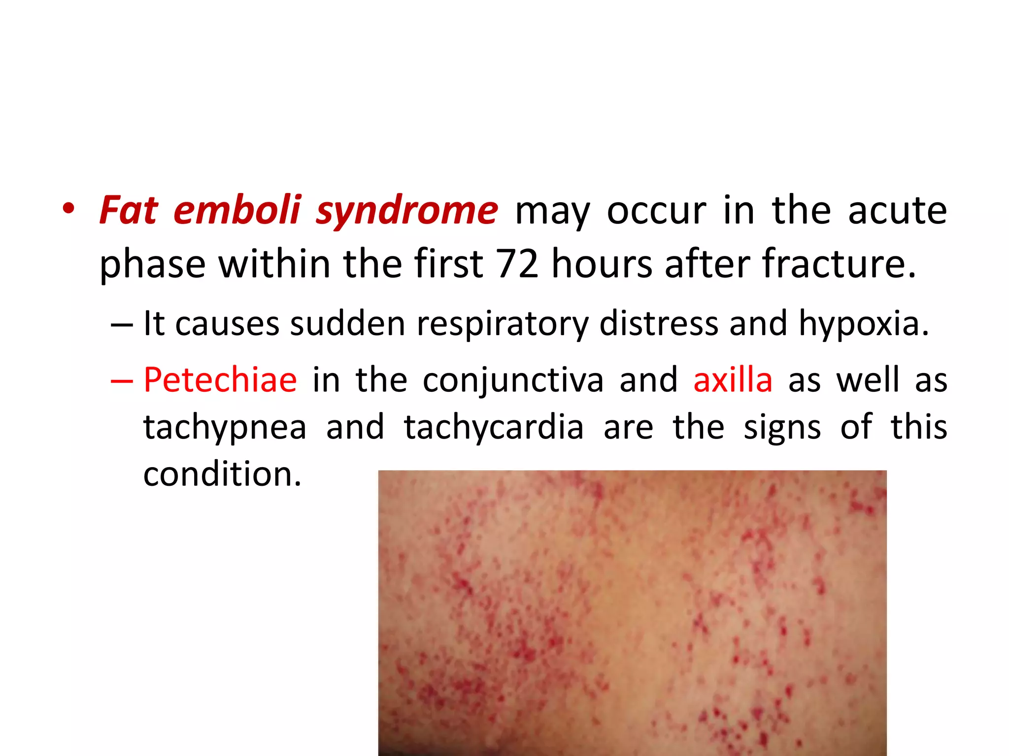 Tibial shaft fractures rehabilitation | PPTX