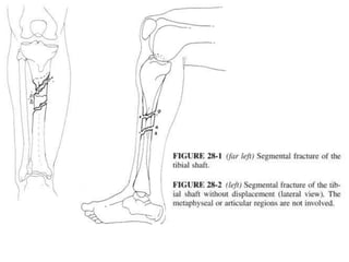 Tibial shaft fractures rehabilitation | PPTX