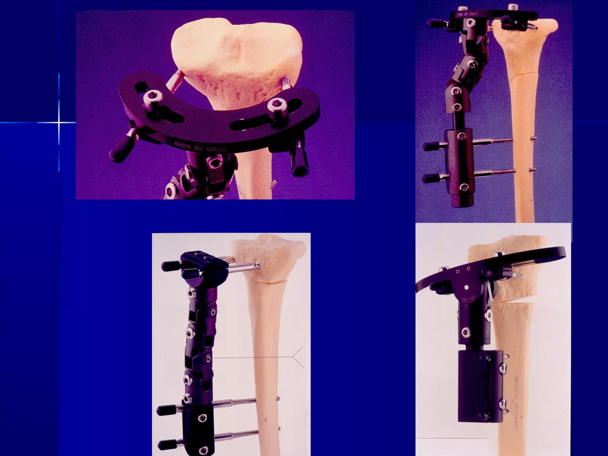 Upper tibial valgus osteotomy using a dynamic external fixator | PPT