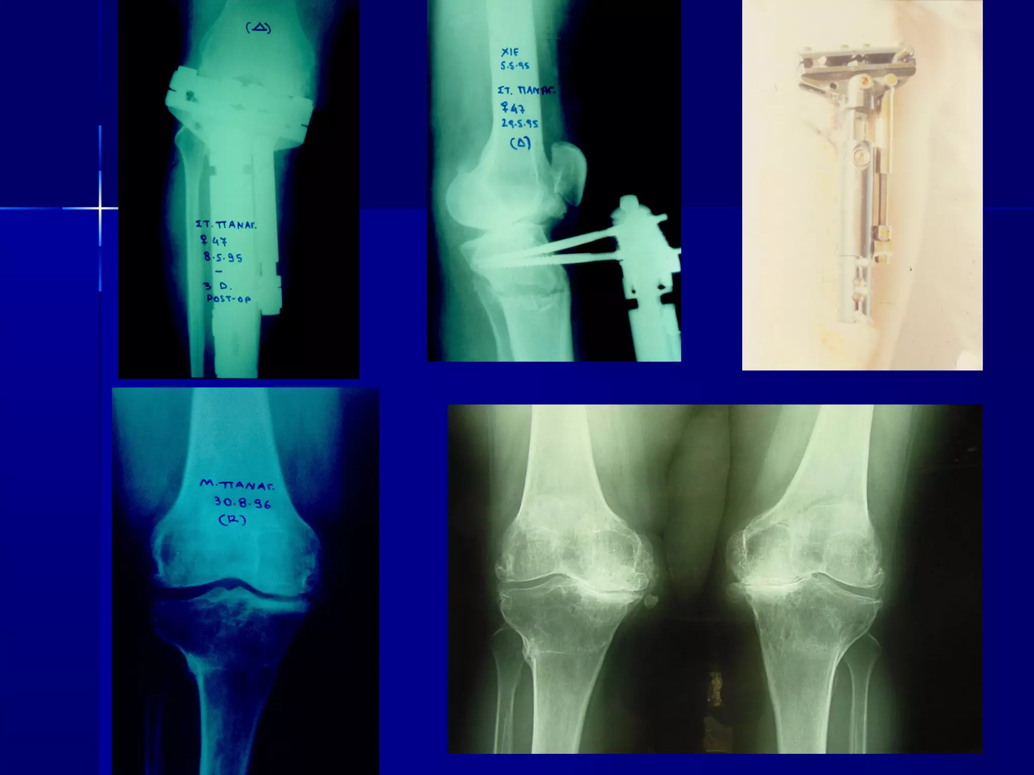 Upper tibial valgus osteotomy using a dynamic external fixator | PPT