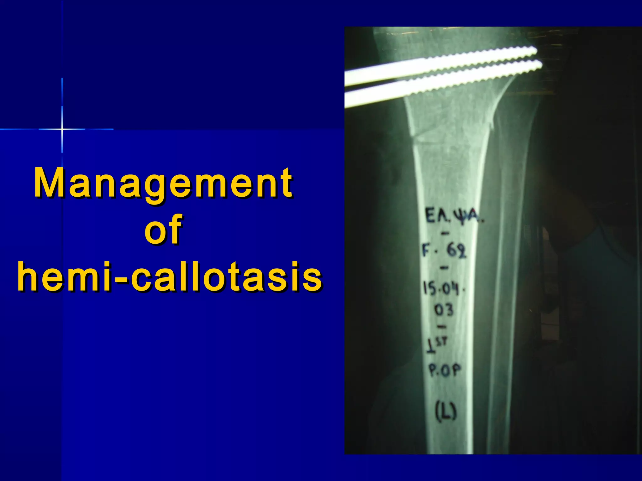 Upper tibial valgus osteotomy using a dynamic external fixator | PPT