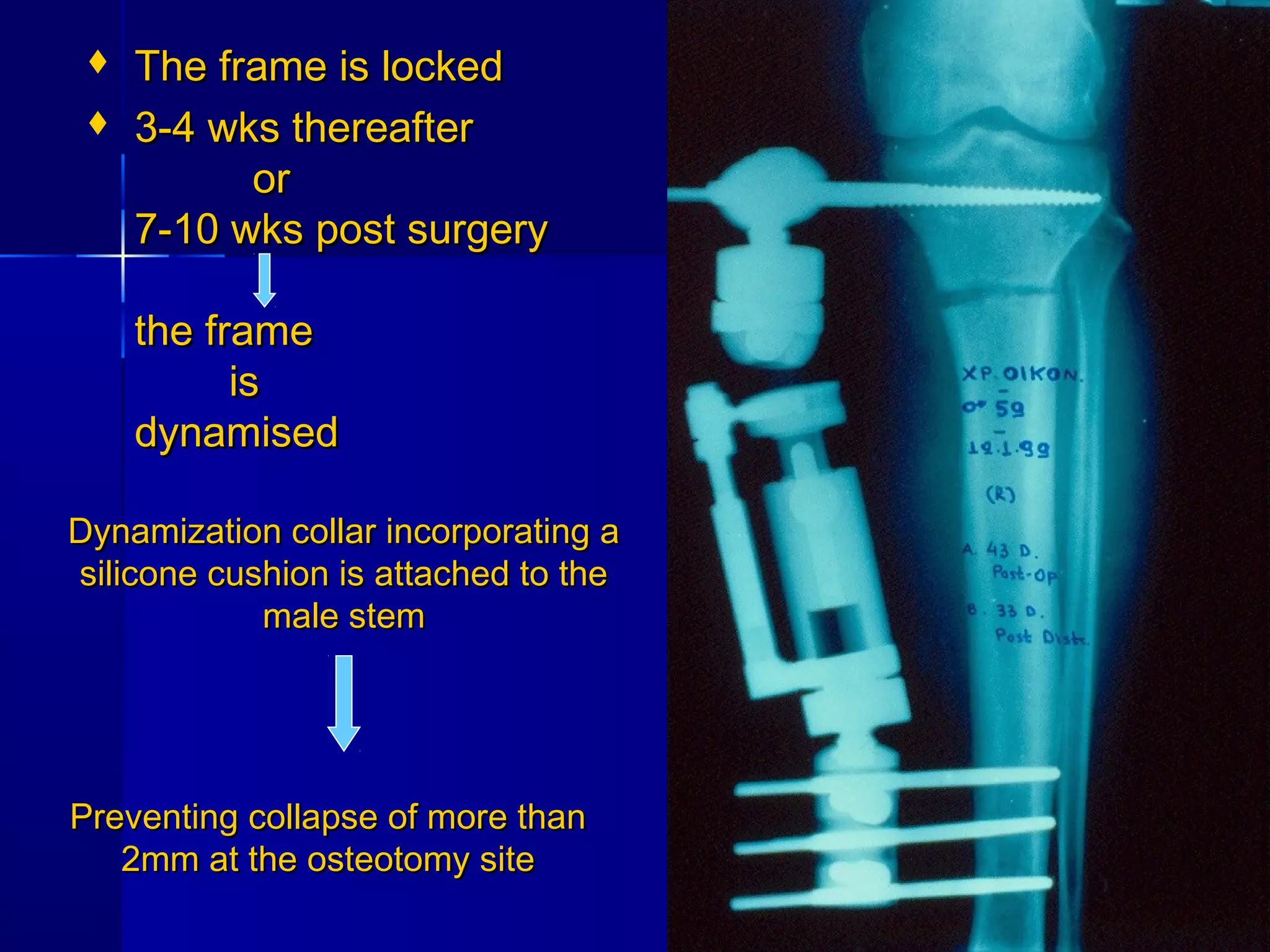 Upper tibial valgus osteotomy using a dynamic external fixator | PPT