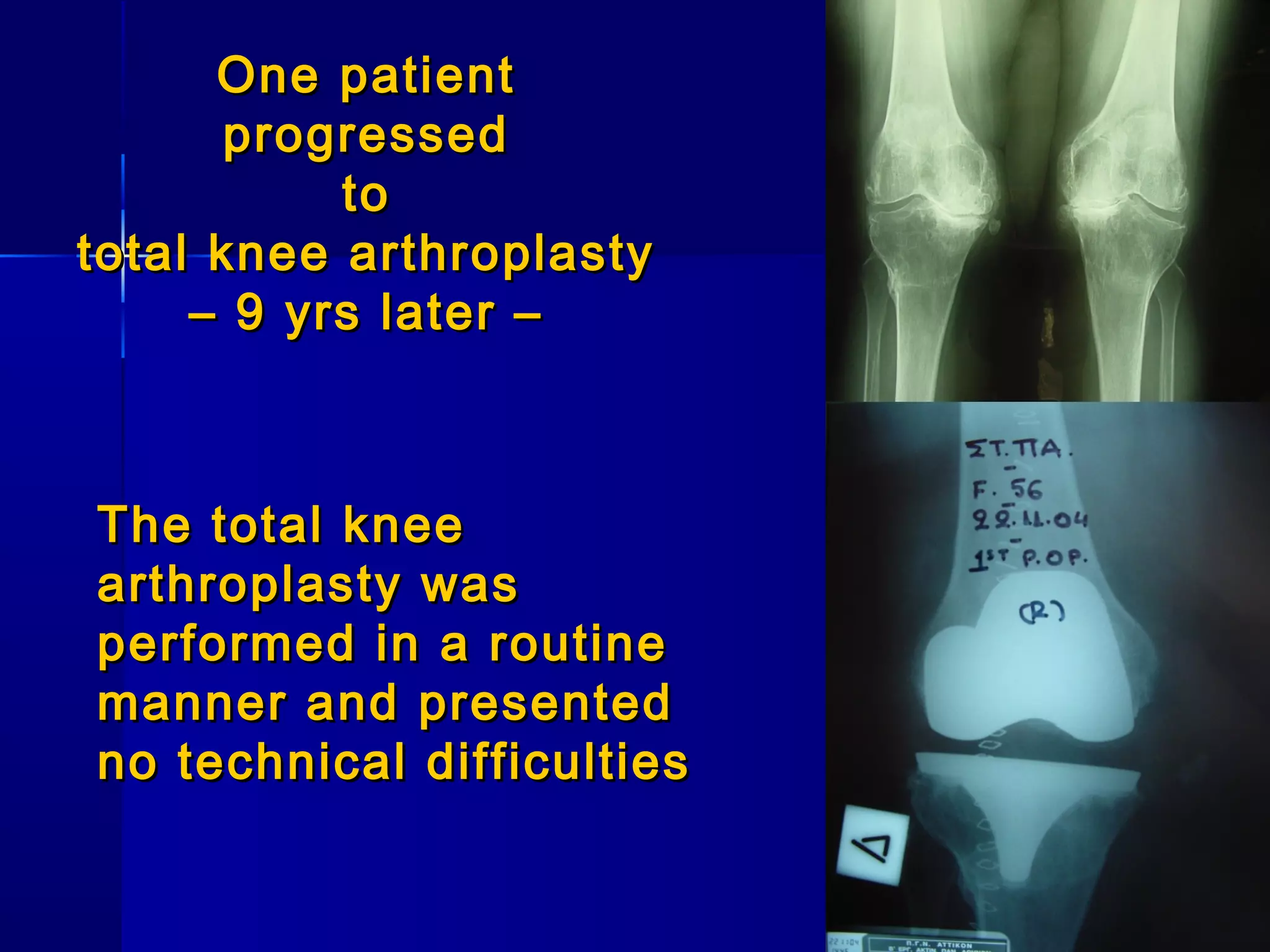Upper tibial valgus osteotomy using a dynamic external fixator | PPT