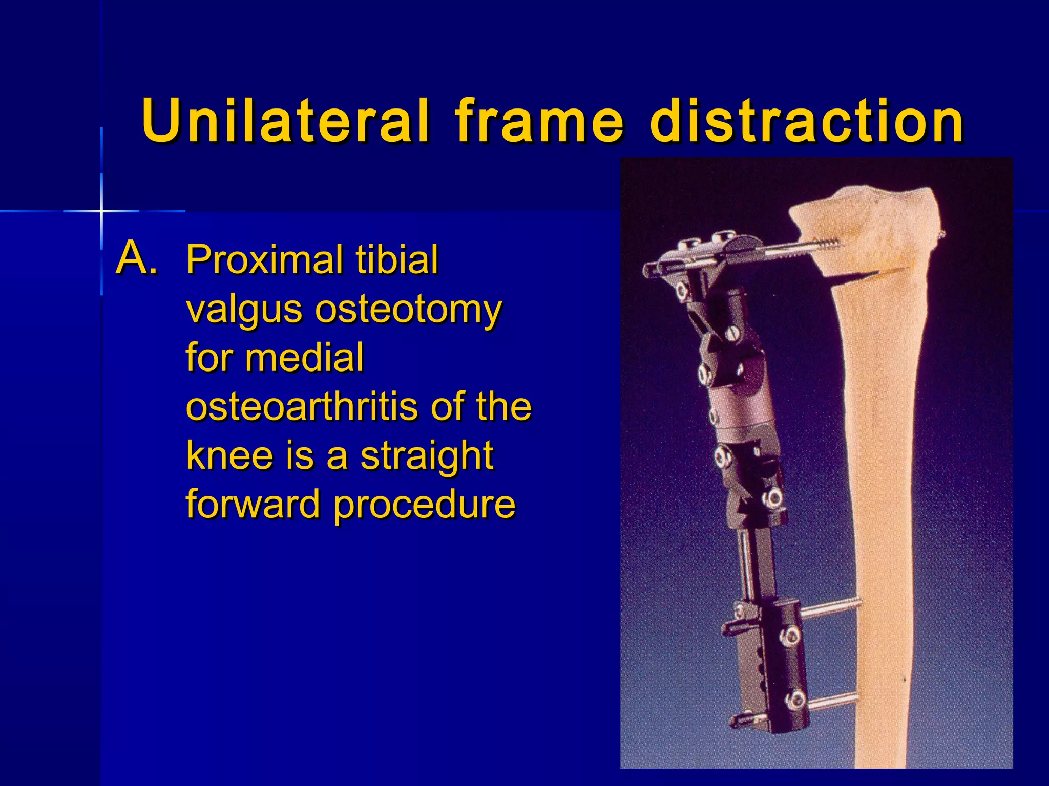 Upper tibial valgus osteotomy using a dynamic external fixator | PPT