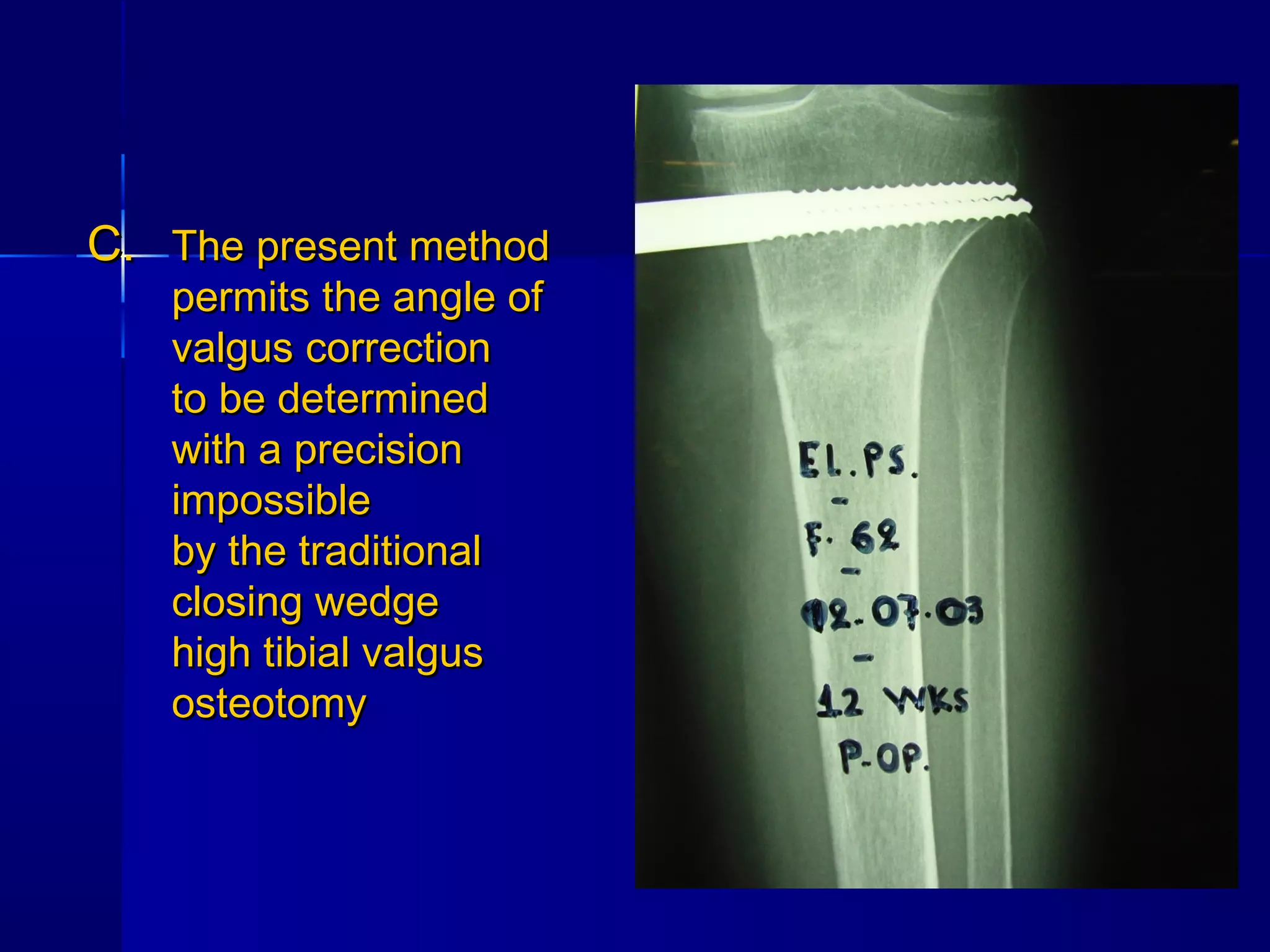 Upper tibial valgus osteotomy using a dynamic external fixator | PPT