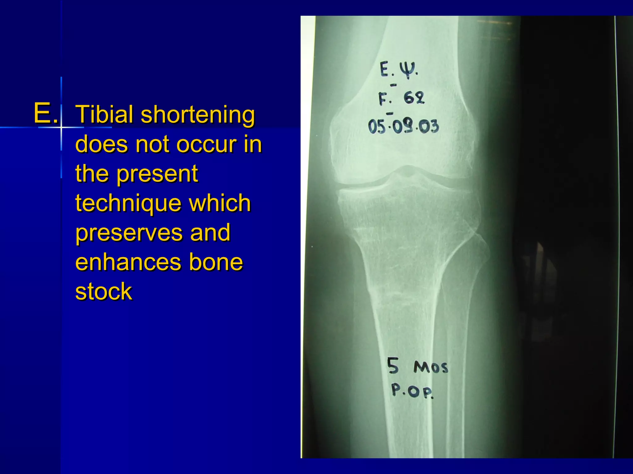 Upper tibial valgus osteotomy using a dynamic external fixator | PPT