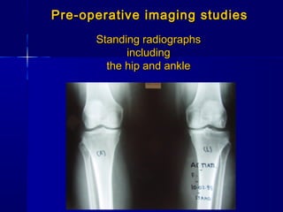 Upper tibial valgus osteotomy using a dynamic external fixator | PPT