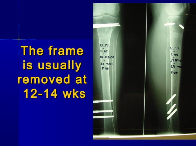 Upper tibial valgus osteotomy using a dynamic external fixator | PPT