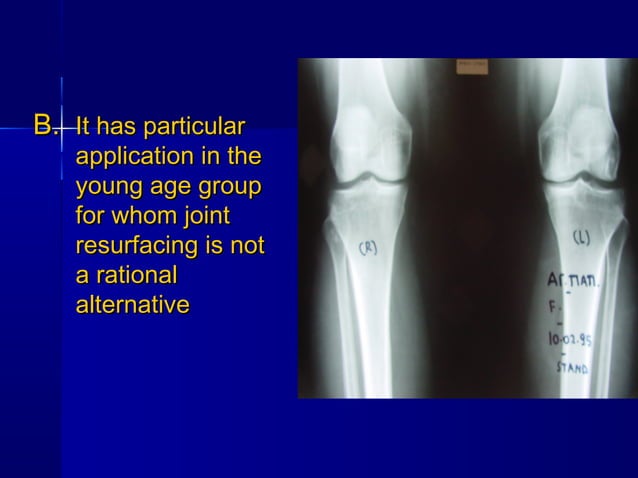 Upper tibial valgus osteotomy using a dynamic external fixator | PPT