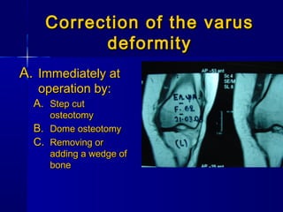 Upper tibial valgus osteotomy using a dynamic external fixator | PPT