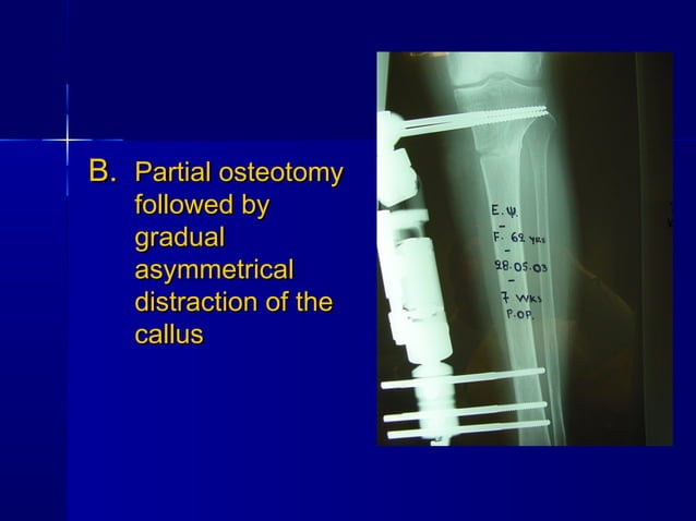 Upper tibial valgus osteotomy using a dynamic external fixator | PPT