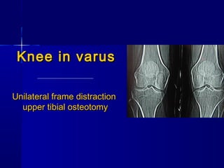 Upper tibial valgus osteotomy using a dynamic external fixator | PPT