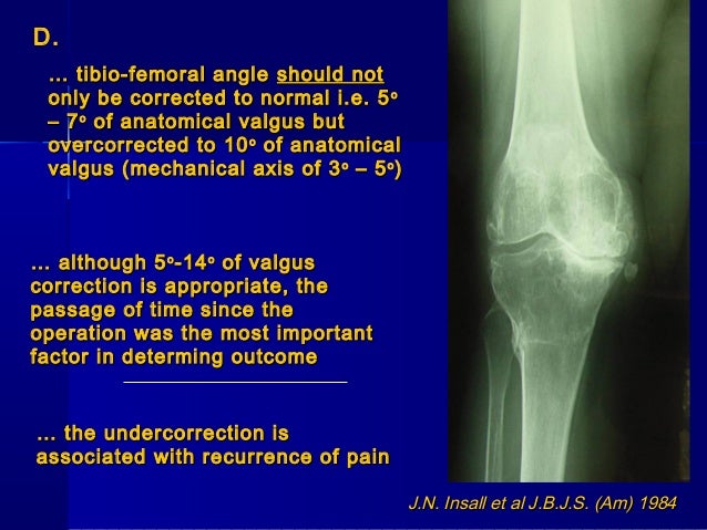 Upper tibial valgus osteotomy vusing a vdynamic external fixator