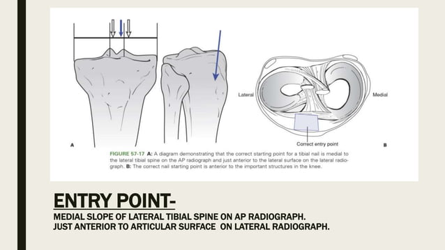 INTERLOCKING TIBIA NAIL IN SHAFT TIBIA FRACTURE PPT BY DR PRATIK | PPTX