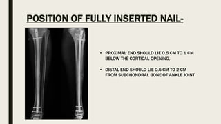 INTERLOCKING TIBIA NAIL IN SHAFT TIBIA FRACTURE PPT BY DR PRATIK | PPT
