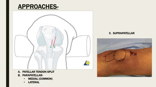 INTERLOCKING TIBIA NAIL IN SHAFT TIBIA FRACTURE PPT BY DR PRATIK | PPT