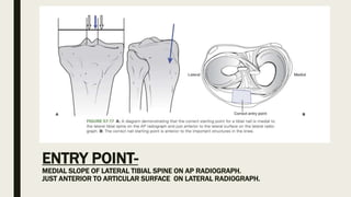 INTERLOCKING TIBIA NAIL IN SHAFT TIBIA FRACTURE PPT BY DR PRATIK | PPT