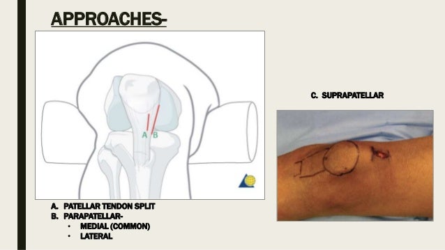 INTERLOCKING TIBIA NAIL IN SHAFT TIBIA FRACTURE PPT BY DR PRATIK