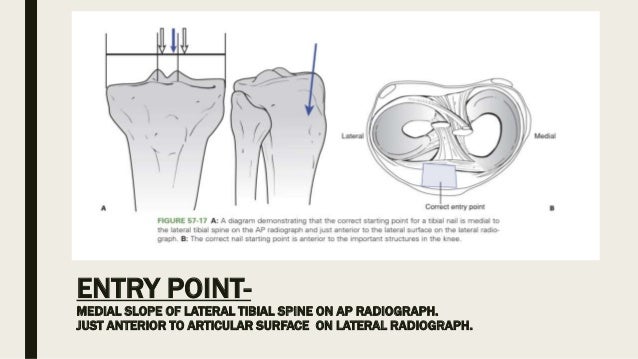 INTERLOCKING TIBIA NAIL IN SHAFT TIBIA FRACTURE PPT BY DR PRATIK