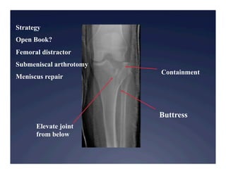 Tibia plateu, shaft, and plafond fractures 2012 | PDF