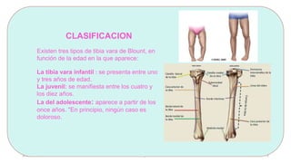 TIBIA VARA (3).pptx