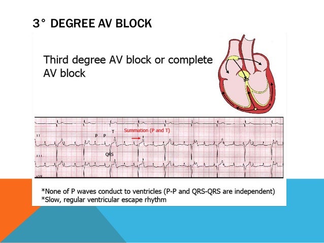 Tier 1 presentation - AV blocks and pacemakers