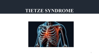 TIETZE SYNDROME: A Rare Disease Chest pain complication .pptx