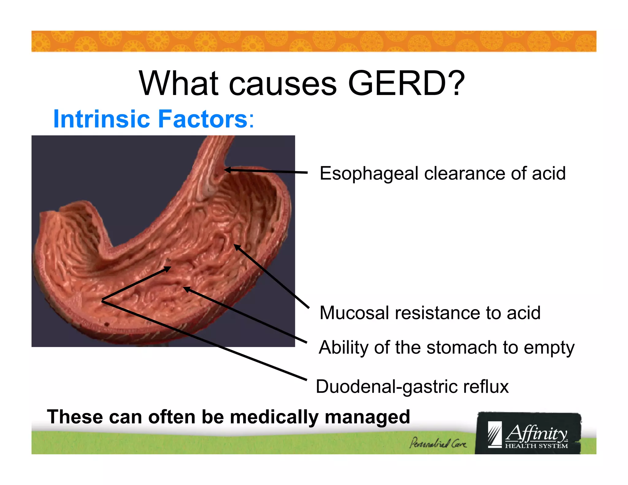 Heartburn and Acid Reflux: Causes & New Treatment Options | PDF