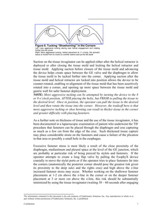 White paper on TIF with Esophyx | PDF