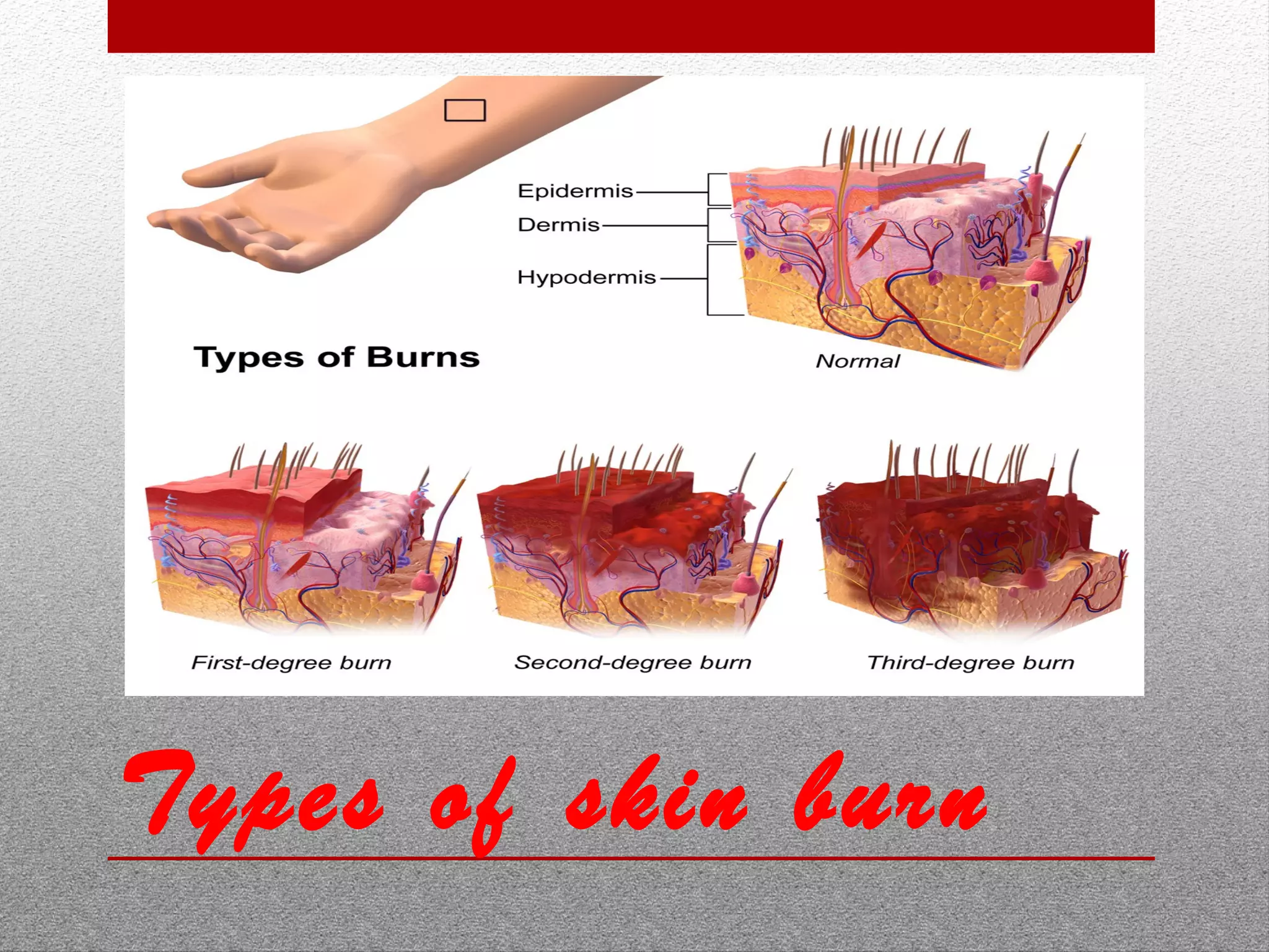 Tilapia skin burn bandage | PPT | First Aid | Injuries