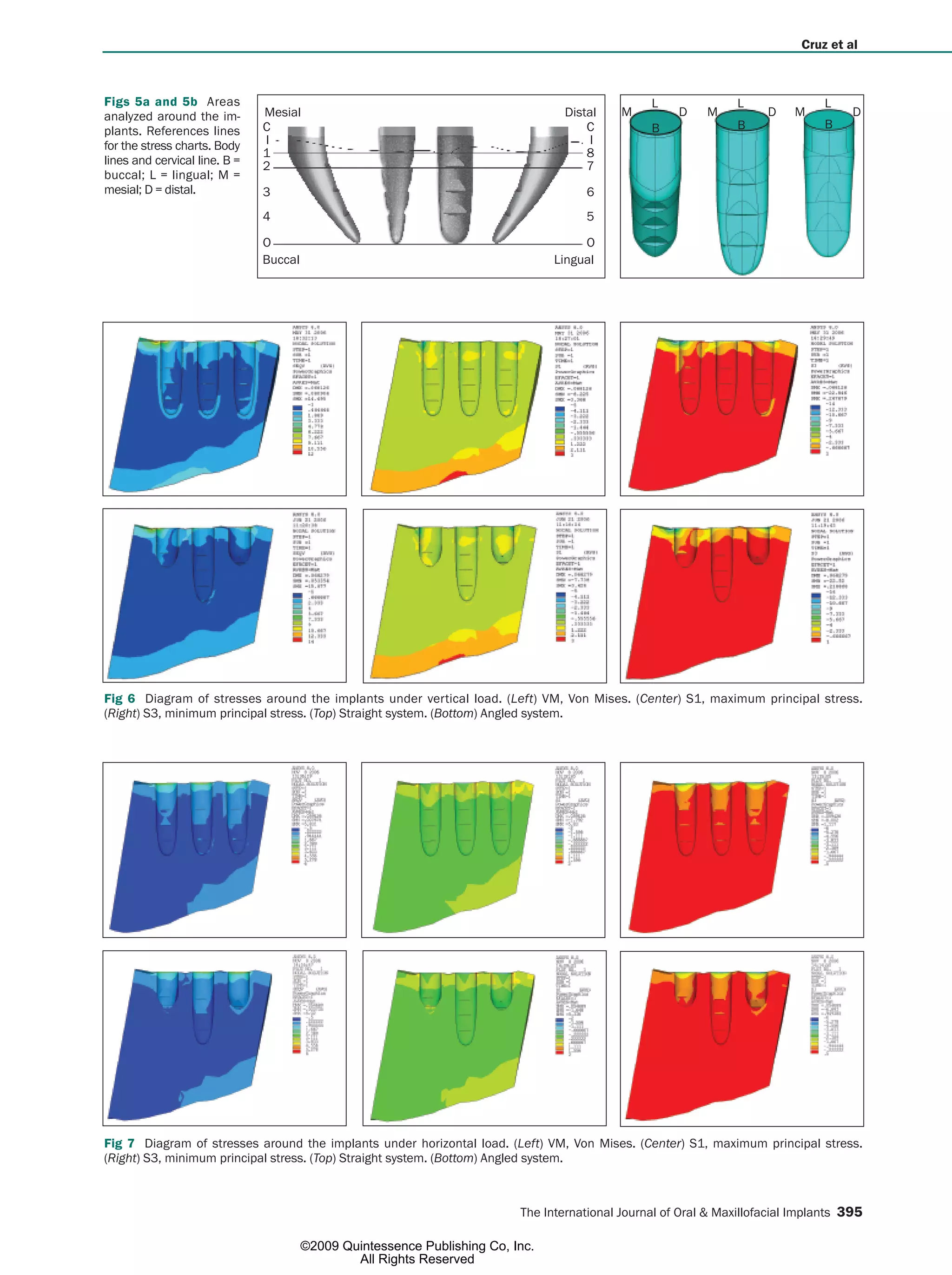 Tilted implants cruz-2009 | PDF