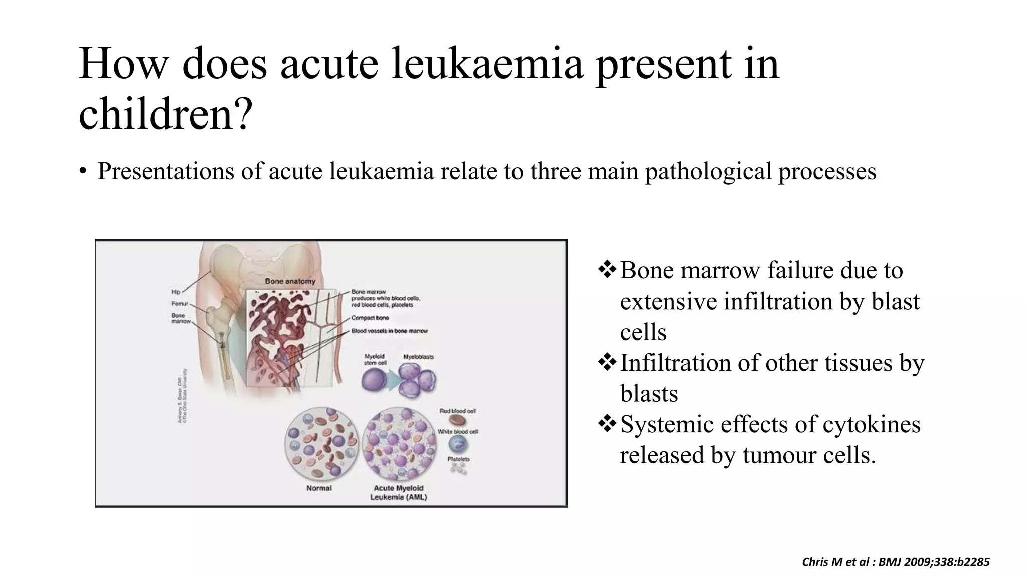Timeliness in diagnosis of acute leukemia in paediatric age group | PPTX