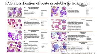 Timeliness in diagnosis of acute leukemia in paediatric age group | PPT