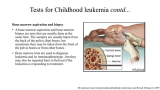 Timeliness in diagnosis of acute leukemia in paediatric age group | PPT