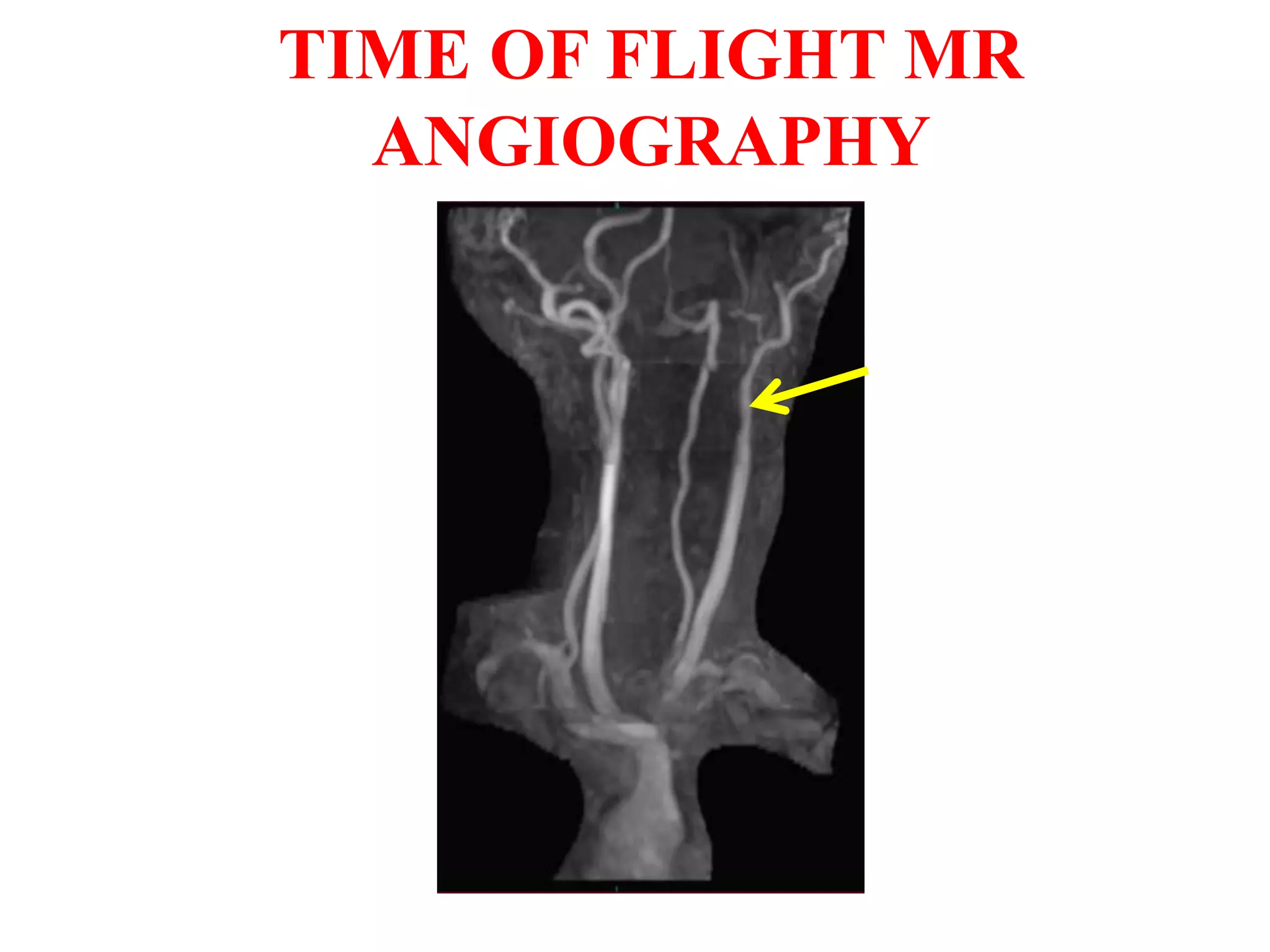 Time of flight mra | PPTX
