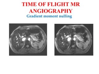 Time of flight mra | PPTX