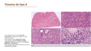 THYMOMA. TUMOR MEDIASTINAL DESCRIPCION.. | PPTX
