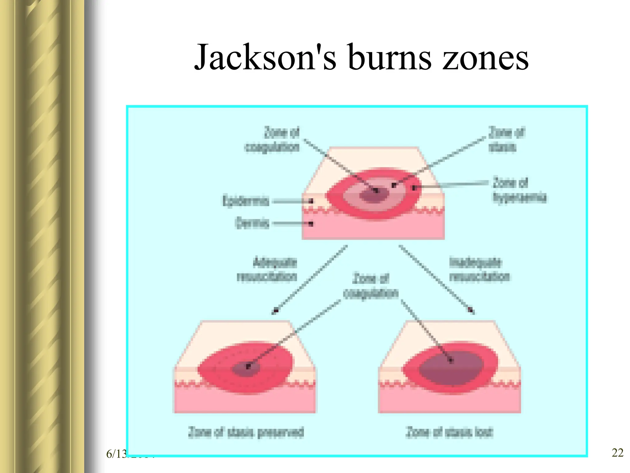 Burn Injury and introduction & physiology | PDF