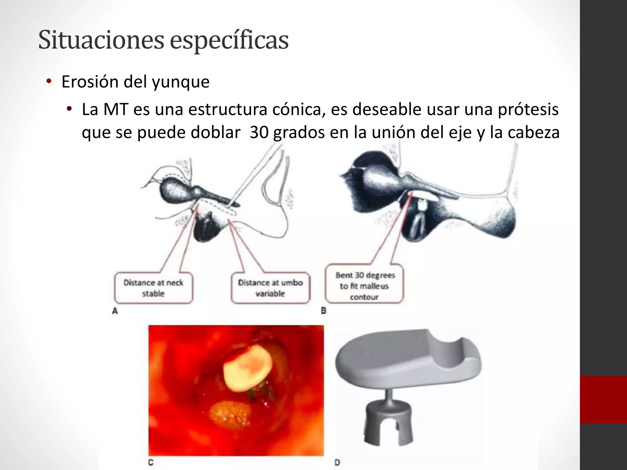 Timpanoplastia | PPT
