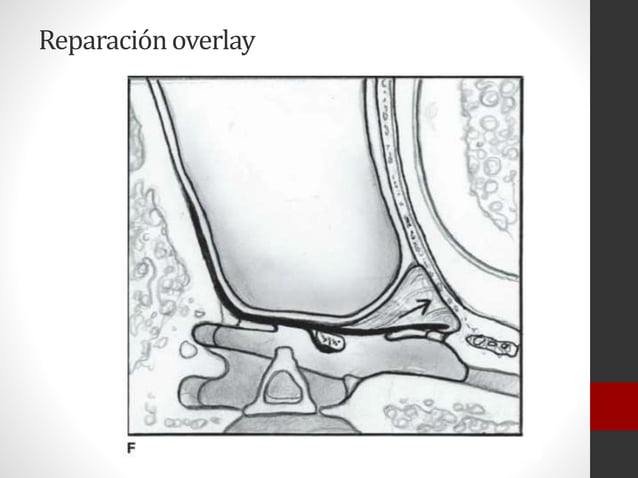 Timpanoplastia | PPTX