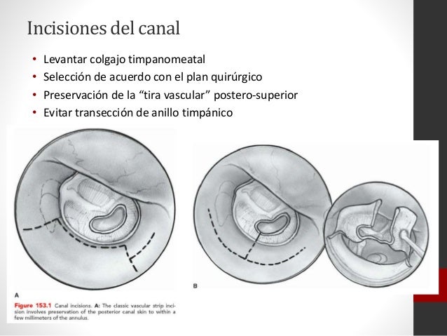 Timpanoplastia
