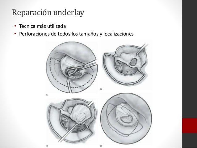 Timpanoplastia