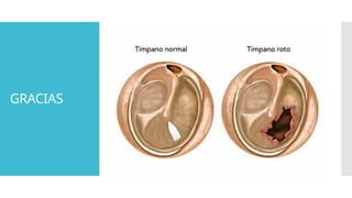 timpanoplastia. TECNICA QUIRURGICA EXPOSICIONICA | PPTX