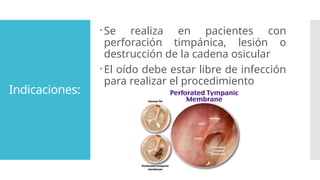 timpanoplastia. TECNICA QUIRURGICA EXPOSICIONICA | PPTX