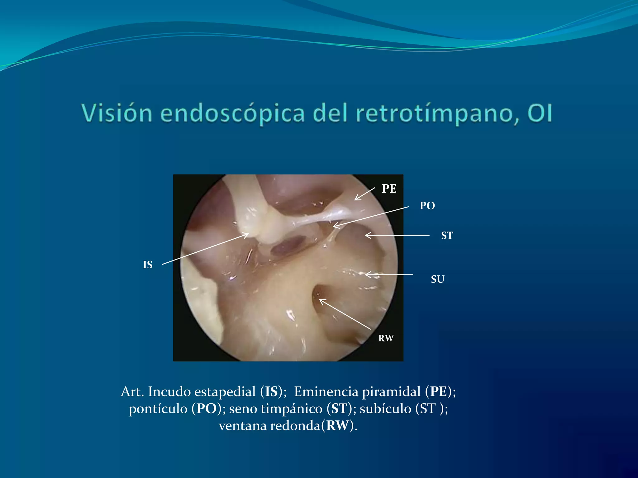 Timpanoplastia Endoscopica Pptx