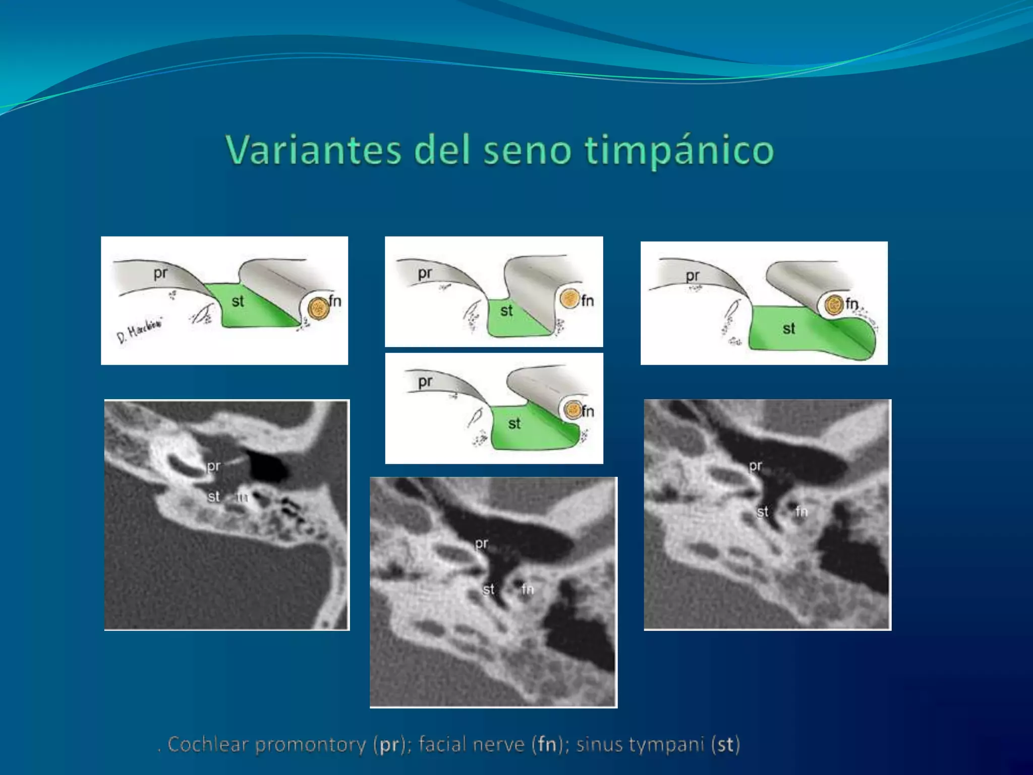 Timpanoplastia endoscopica | PPTX